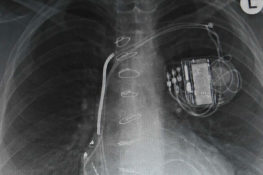 World’s First Pacemaker Powered By A Mechanical Watch Movement ...